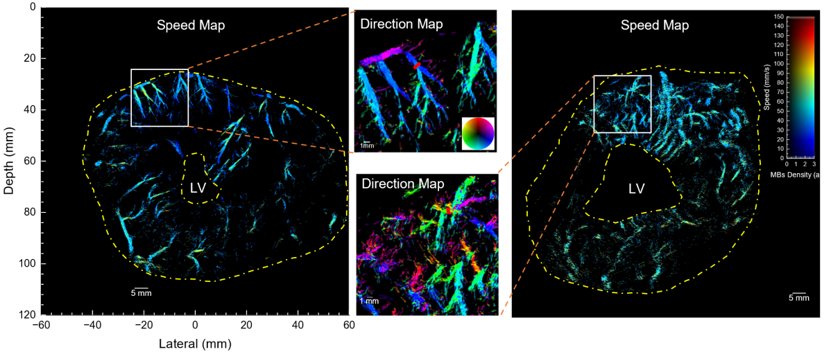 Transthoracic ultrasound localization microscopy of myocardial ...